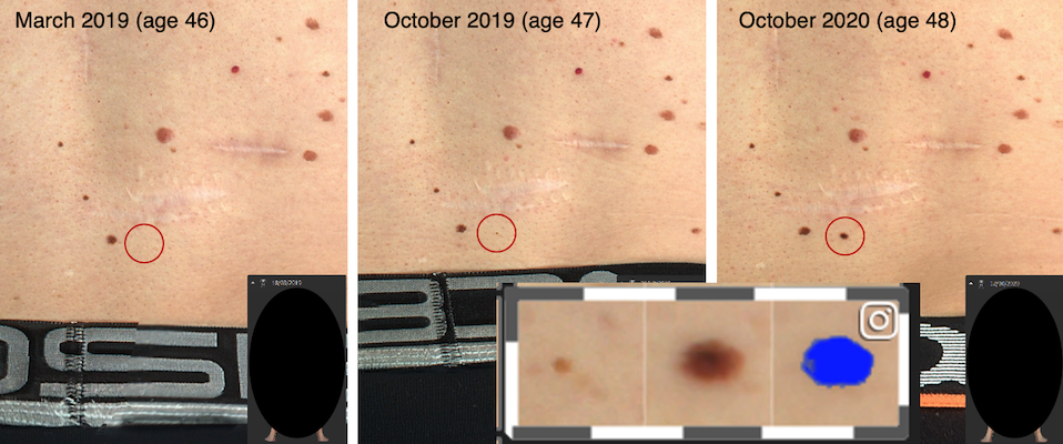 Clinical trial first step towards melanoma screening program | Melanoma ...